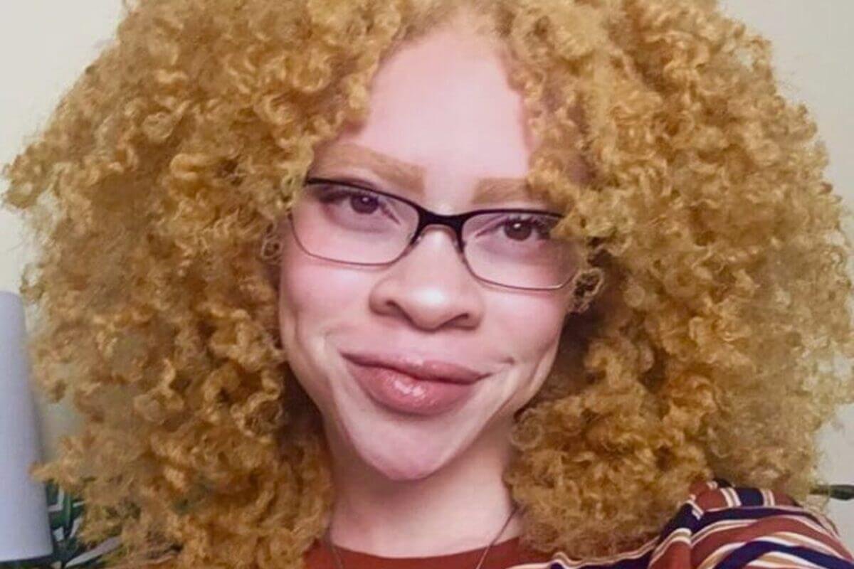Iyana LeShea: Rising Above Albinism With Confidence